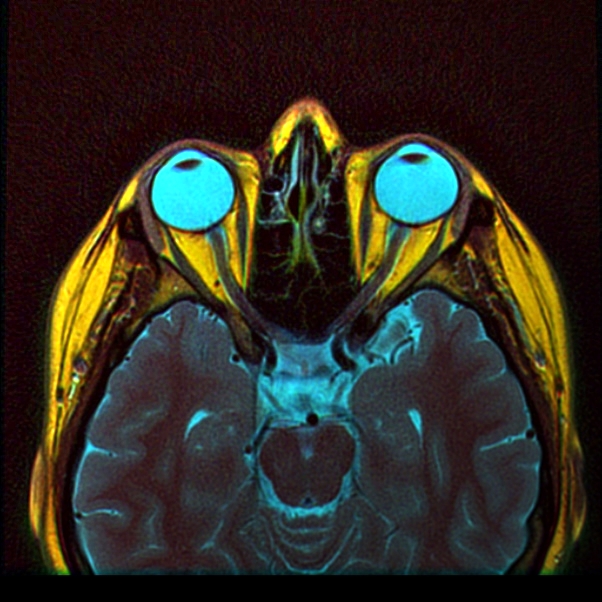 Nevit's blog: Color MRI of Orbita