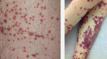 20 Ciri-ciri Demam Berdarah Dengue (DBD) ~ PUSKESMAS KANDANGAN