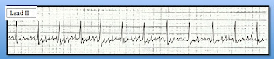 ECG Interpretation: ECG Interpretation Review #44 (AFib - Flutter ...