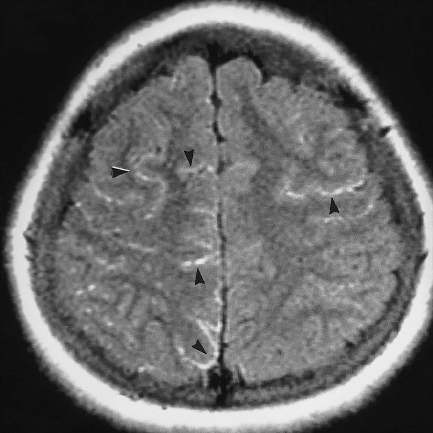 ABC Radiology Blog: Ivy Sign