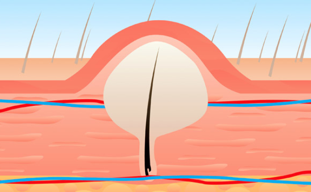 Pengobatan Kulit Folikulitis Secara Alami ~ Toko Obat Herbal ...