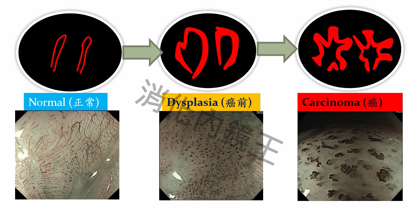 消化內鏡王 - King of digestive endoscopy : IEE在食道的應用