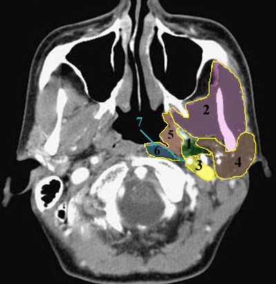 Radiologist For Ever: Parapharyngeal space rule 1:Anatomy and pathology