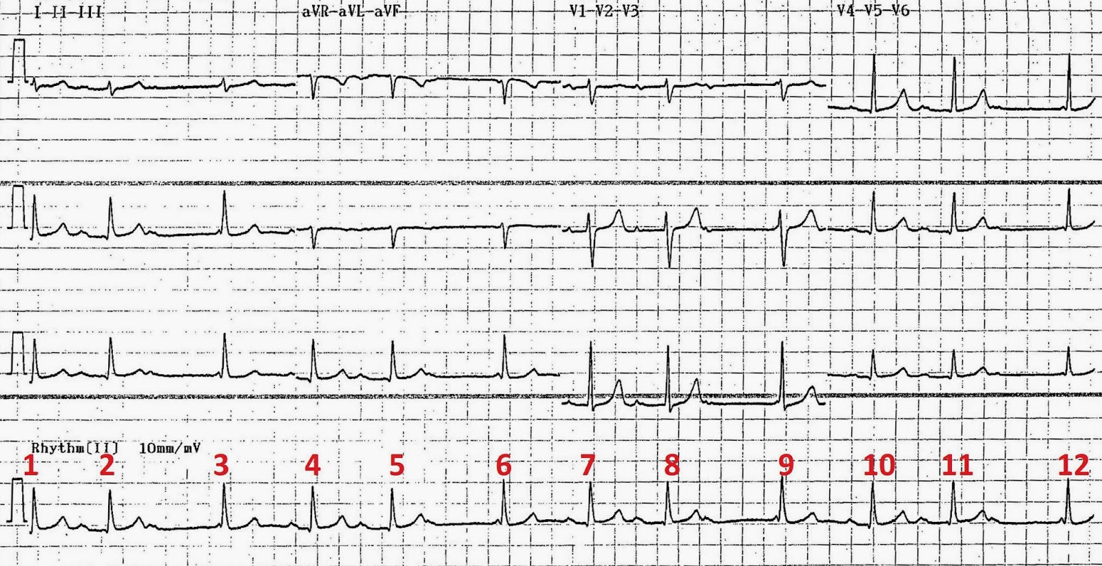 ECG of the Week: ECG of the Week - 3rd February 2014 - Interpretation