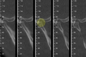 My Lingual Frenectomy and Orofacial Therapy: Recent Orthodontic ...