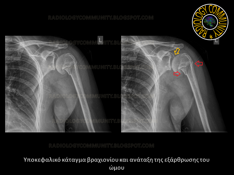 Radiology Community: Κάκωση Ώμου από πτώση - Ακτινογραφική προσέγγιση