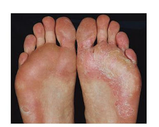 Tinea pids ( Athlete's foot ) -Symptoms, treatment and prevention ...