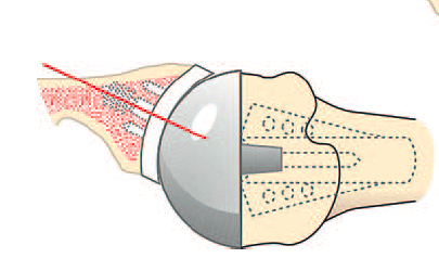 Shoulder Arthritis/Joint Replacement Rotator cuff tears: Managing ...