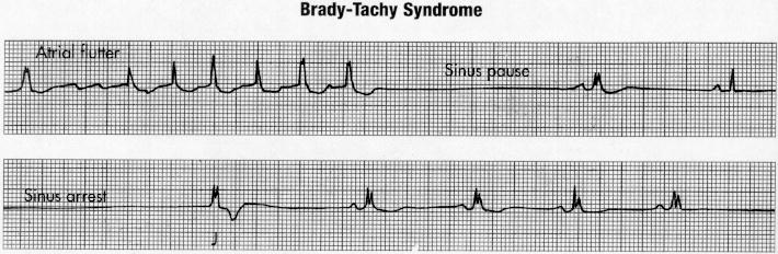 Sick Sinus Syndrome | INA - ECG