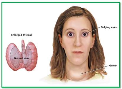 مدونة كلية طب الأسنان الجوف: Complications Of Hyperthyroidism