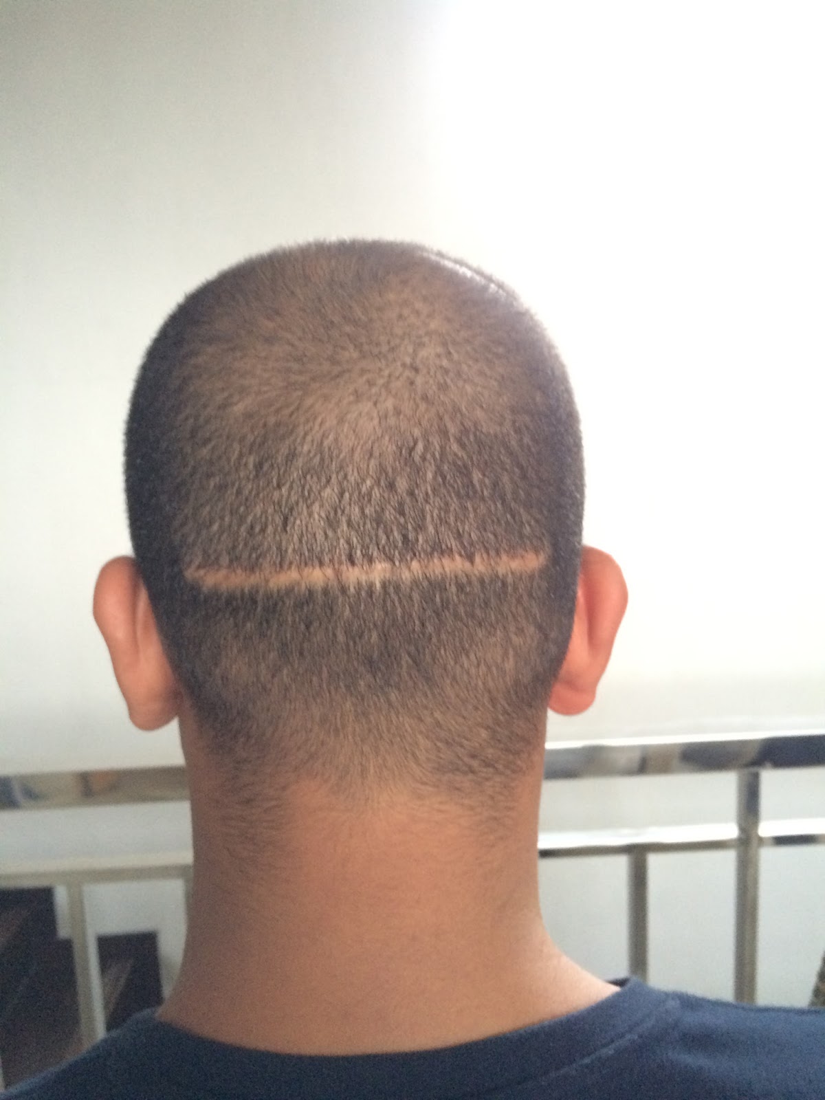 hair transplant experience - pengalaman transplantasi rambut / tanam ...