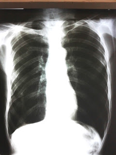 DICAS DE RADIOLOGIA - Tudo Sobre Radiologia: IMAGENS RADIOLÓGICAS - RADIOGRAFIA DE FRATURA COSTELA