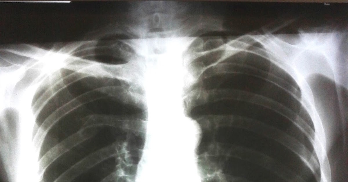 Costela Quebrada Raio X - RETOEDU