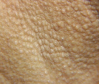 Doenças Raras Doem®: Doença de Fox-Fordyce