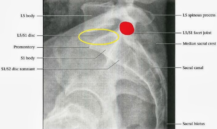 ABC Radiology Blog: Lumbarization & sacralization