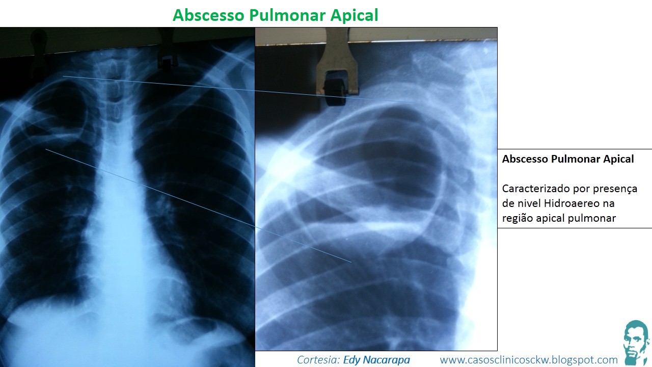 Casos Clinicos: Abscesso Pulmonar