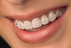 Dr Tiago Eubank Ortodontia e Estética Sorria mais Feliz: APARELHO ESTÉTICO