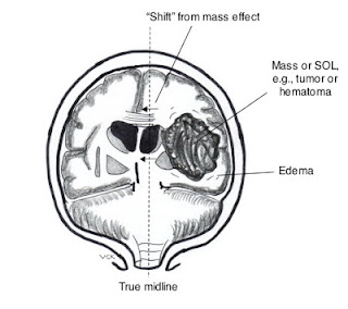 Space Occupying Lesion (SOL) | DUNIA KEPERAWATAN