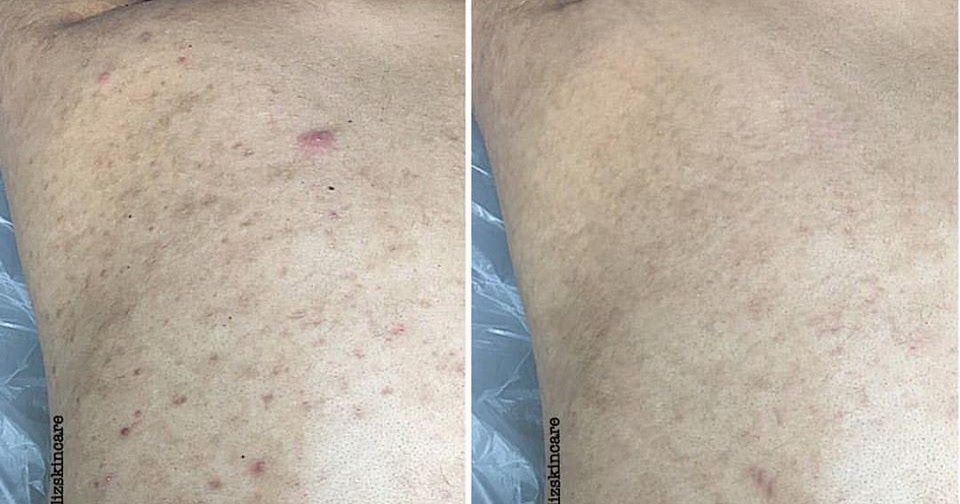 Liz Skincare Miami Wellness Beauty Lifestyle Blog : Body Bleaching for ...