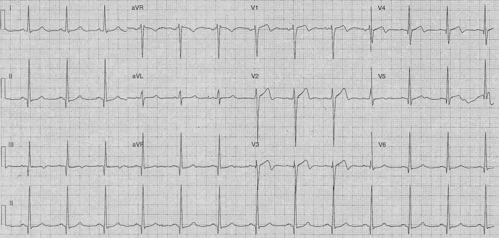 ECG of the Week: ECG of the Week - 25th November 2013 - Interpretation