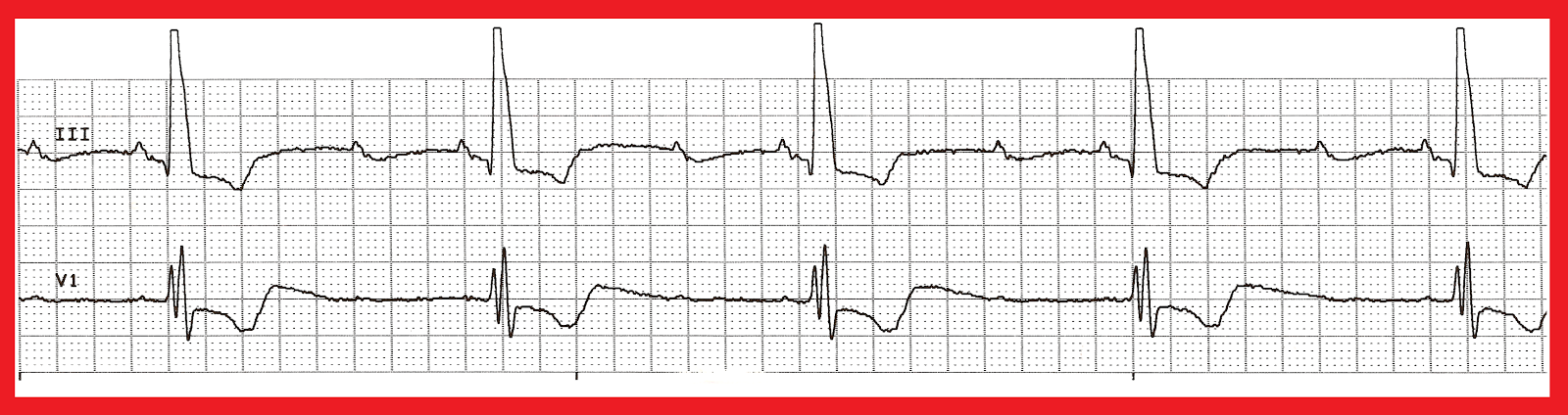 Basic EKG Rhythm Test 22
