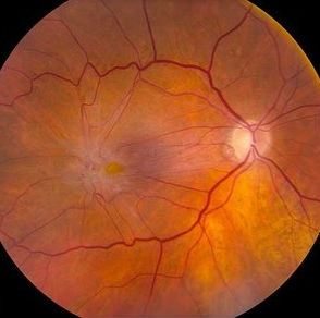 E.R.M EpiRetinal Membrane Disease