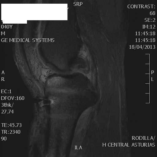 Salud Osteoarticular: LUXACION DE RODILLA