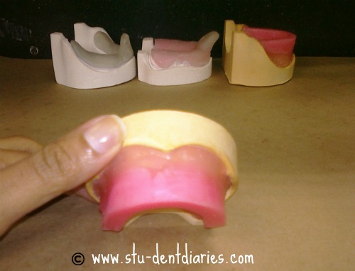 Stu-DENT Diaries: Custom Tray, Record Base and Wax Rim