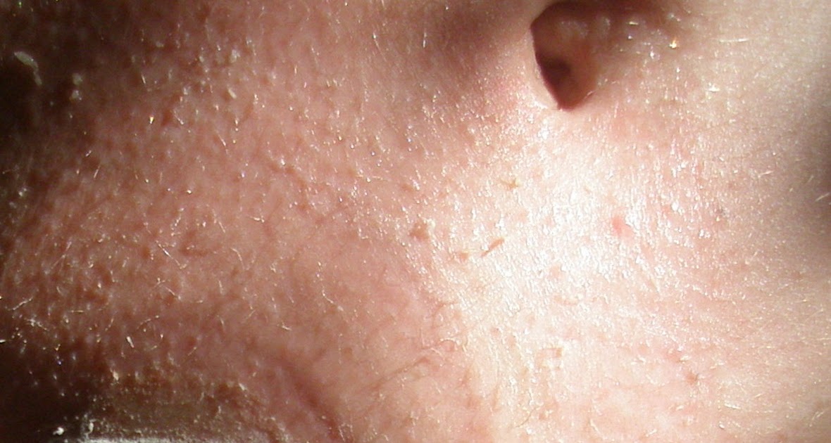 Adventures with a Rebellious Colon: Surgery #2 in Sight (Graphic stoma ...