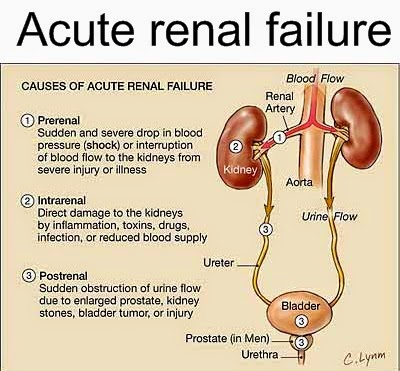Medical Emergencies by Chathurika: Acute Renal Failure