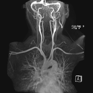 The Pump and the Tubes: MR + C (Static contrast-enhanced MRA)