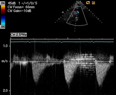 Pedi cardiology: Echo: Descending aorta Doppler Pattern, s/p Repair of ...