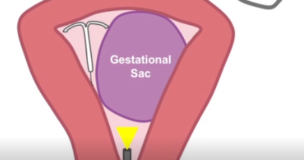 Ob/Gyn Updated : ASRM Video article: Hysteroscopic removal of IUD in ...