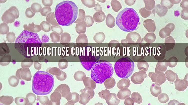 Biomedicina em Foco: Leucocitose com presença de blastos