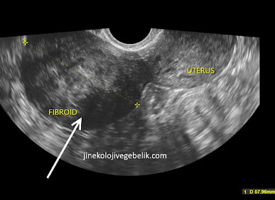 MİYOM GÖRÜNTÜLERİ