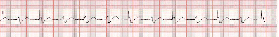 EKG Rhythm Strip Quiz 56: Paced Rhythms