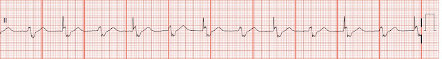 EKG Rhythm Strip Quiz 56: Paced Rhythms