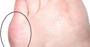 Bunionette Treatment - 6 Effortless Ways