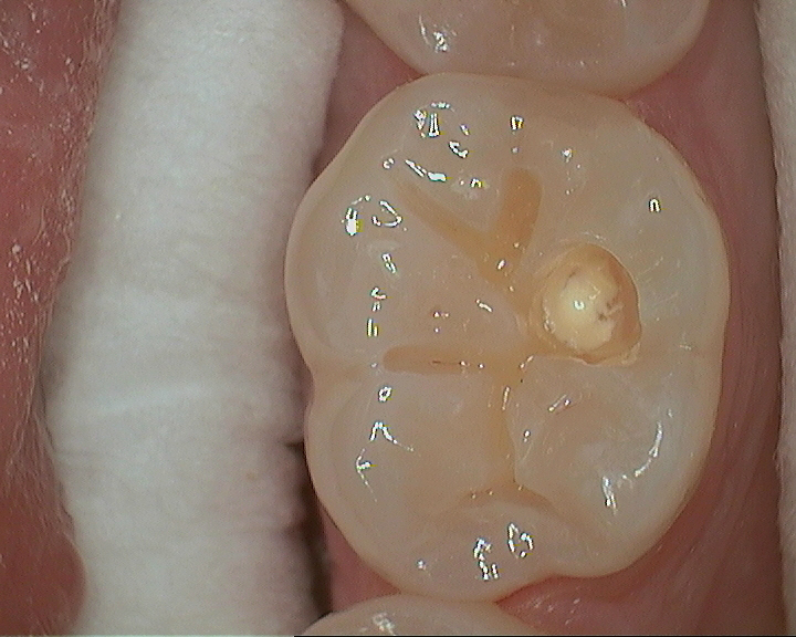 sweet tooth: occlusal caries