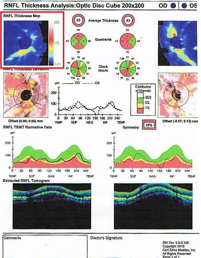 GLAUCOMA SPECIALIST BLOG: "THE GLOG"