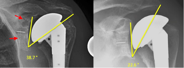 UW Shoulder and Elbow Academy: The critical shoulder angle after total ...