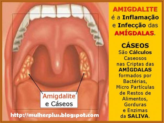 Doenças de criança I: Amigdalite - Maria Amélia Jaques Dias