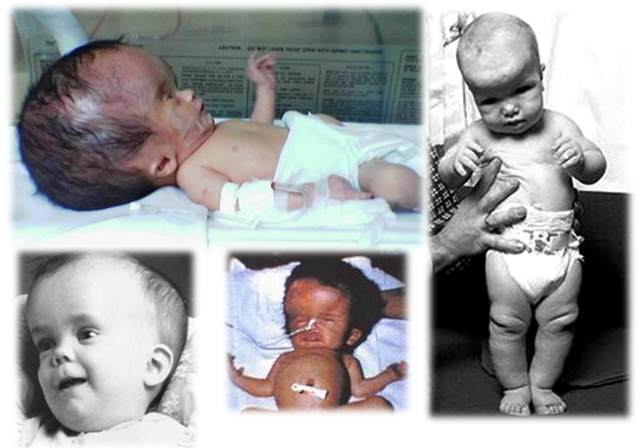 Neurociências em benefício da Educação!: Macrocefalia e Microcefalia