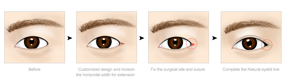 COOKI PLASTIC SURGERY │ All about eye surgery: Canthoplasty (2)