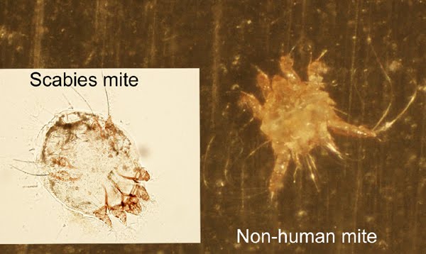 Scabies Mite Size
