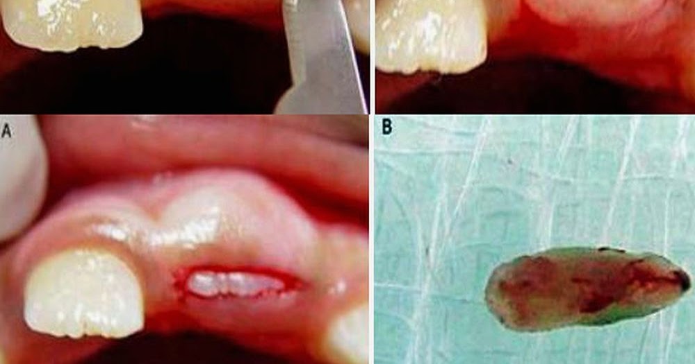 ODONTOPEDIATRIA : O que é Ulectomia? - odontobebe