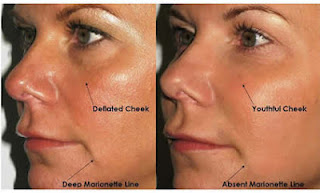 DermaSphere: Vampire Face Lift