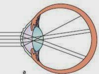 Pengertian Astigmatisma - cekrisna