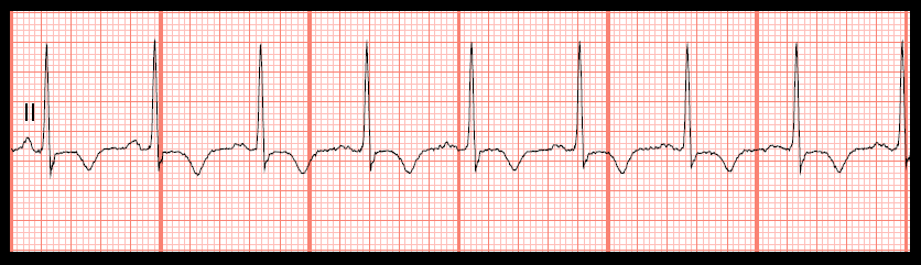 Float Nurse: Practice EKG Strips