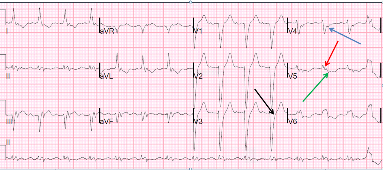 Dr. Smith's ECG Blog: CHF Exacerbation with Old LBBB: Is There New ...